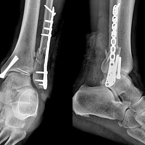 Anatómica Peroné Distal Lateral | INNOMED | Fabricantes material de ...